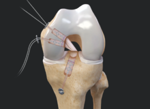 PCL Surgery - 7Scope Ortho Care