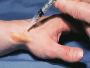 De Quervain’s tenosynovitis - 7Scope Ortho Care
